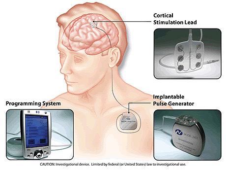 Northstar Neuroscience Cortical Stimulation Device - 普象网